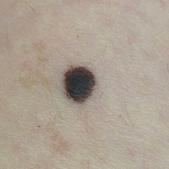 Skin Cancer Diagnosis – Online Detection of Skin Cancer